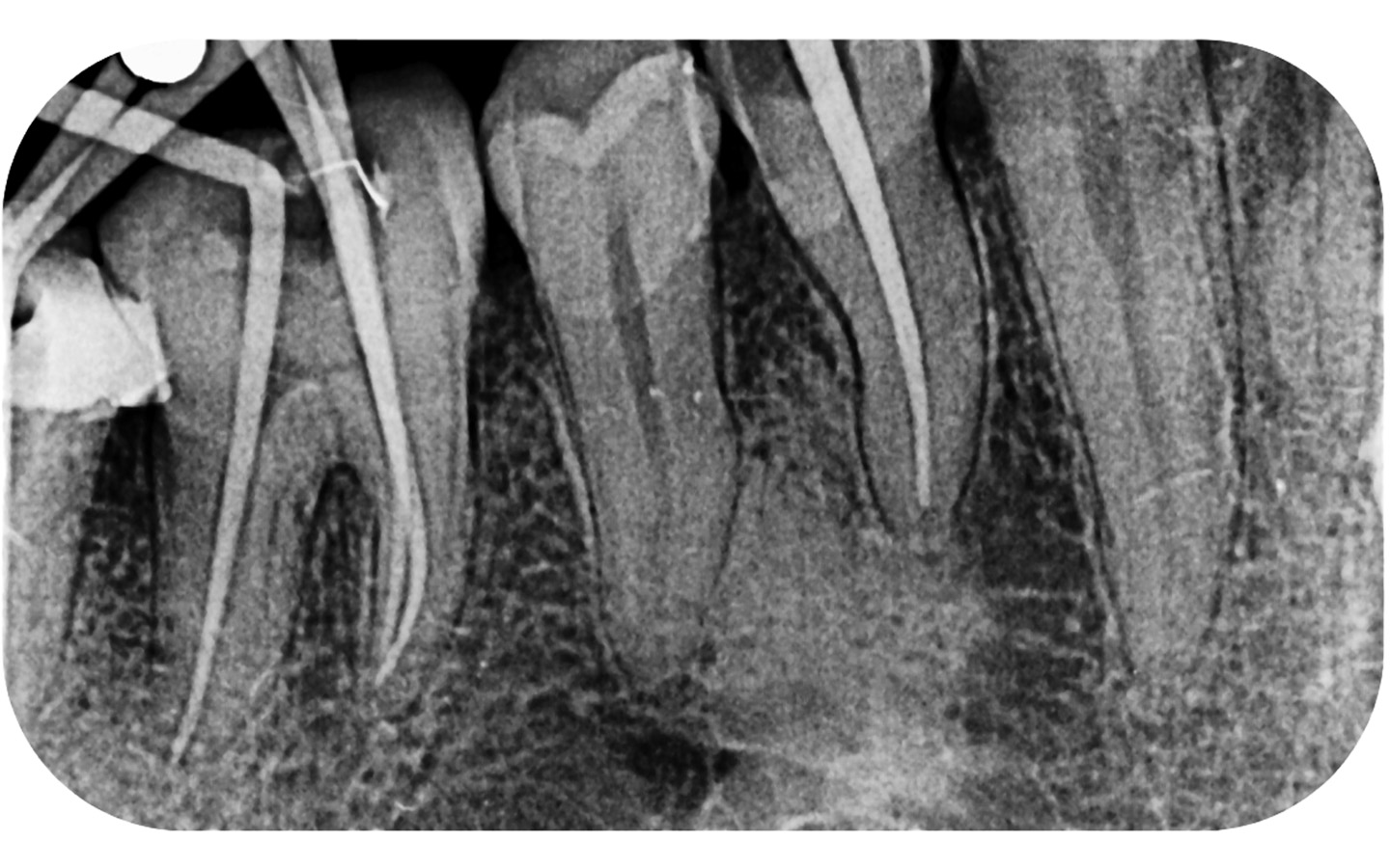 Визиограф интраоральный цифровой рентгеновской визуализации i-Sensor H1, i-sensor H1 — купить в ...